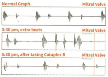 Heart Sound Recorder Westchester CA - Personal Touch Chiropractic